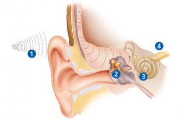 Bone conduction hearing devices and implants (BCHDs and BCHIs) - South ...