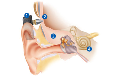 Bone conduction hearing devices and implants (BCHDs and BCHIs) - South ...