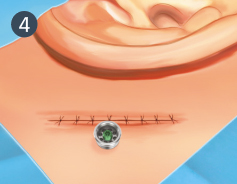 Bone conduction hearing devices and implants (BCHDs and BCHIs) - South ...