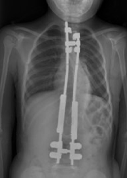 Growing rods - South Tees Hospitals NHS Foundation Trust