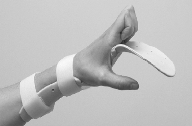 Advice and exercises following your extensor tendon repair - South Tees ...