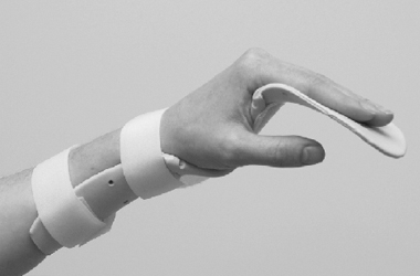 Advice and exercises following your extensor tendon repair - South Tees ...