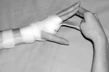 Advice and exercises following your extensor tendon repair - South Tees ...