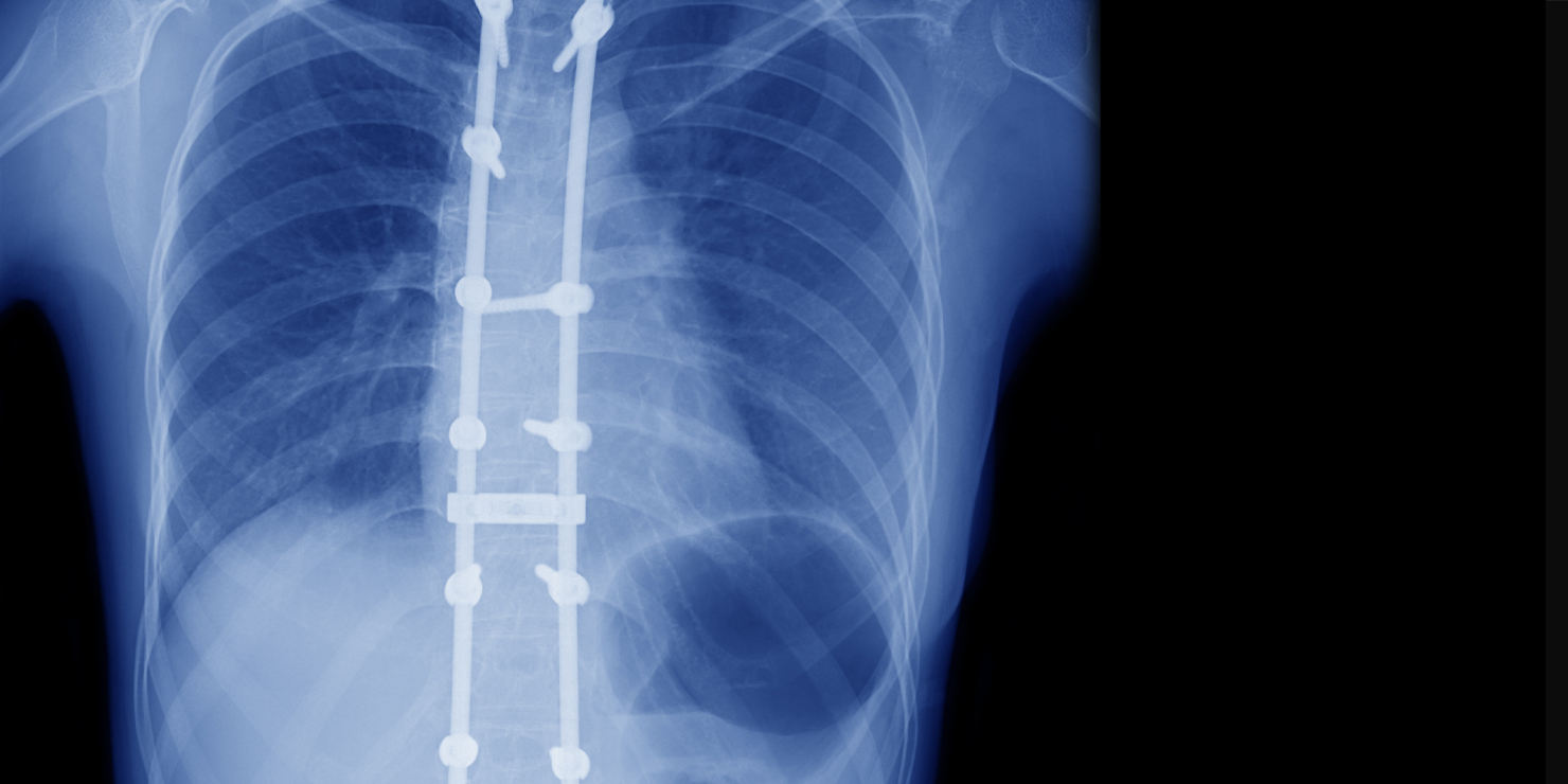 Growing rods - South Tees Hospitals NHS Foundation Trust