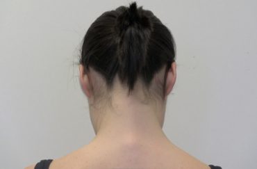 Cervical spine flexion range of movement - South Tees Hospitals NHS ...