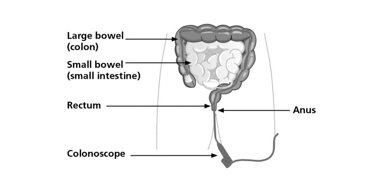 Colonoscopy - South Tees Hospitals NHS Foundation Trust