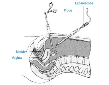 Interval debulking surgery - South Tees Hospitals NHS Foundation Trust