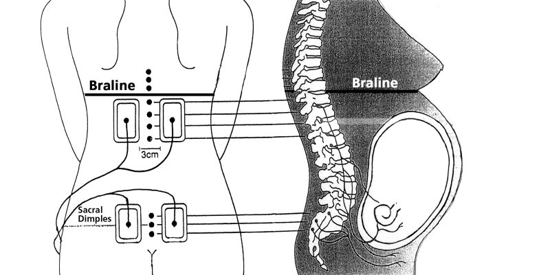 T.E.N.S (Transcutaneous Electrical Nerve Stimulation) Use in labour ...