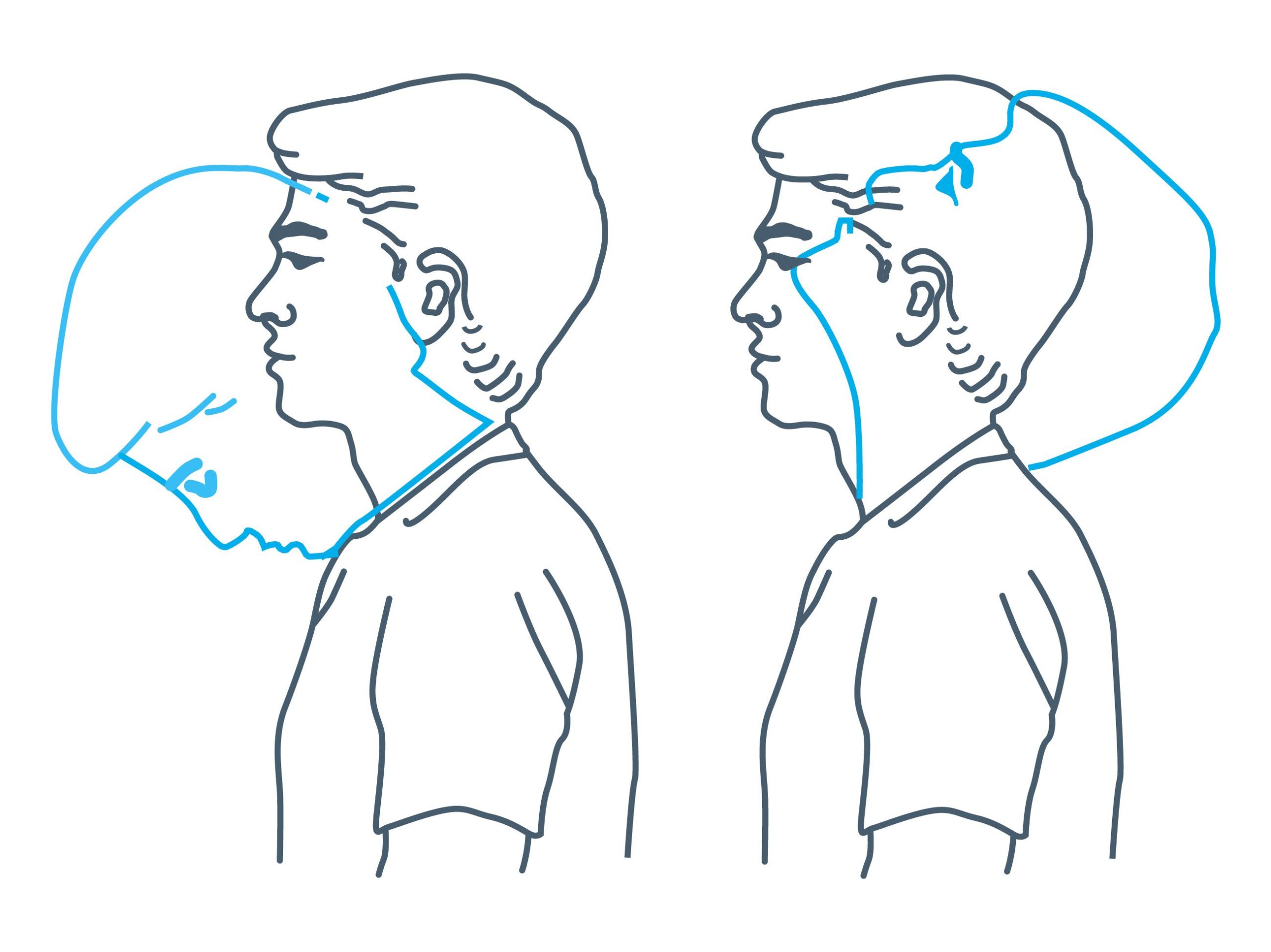 Neck dissection – Treatment and aftercare - South Tees Hospitals NHS ...