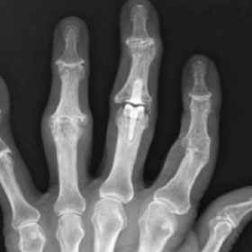 Advice and exercises following PIPJ replacement - South Tees Hospitals ...