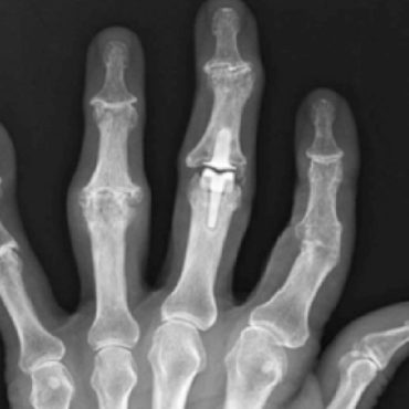 Advice and exercises following PIPJ replacement - South Tees Hospitals ...