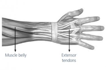 Advice and exercises following your extensor tendon repair - South Tees ...