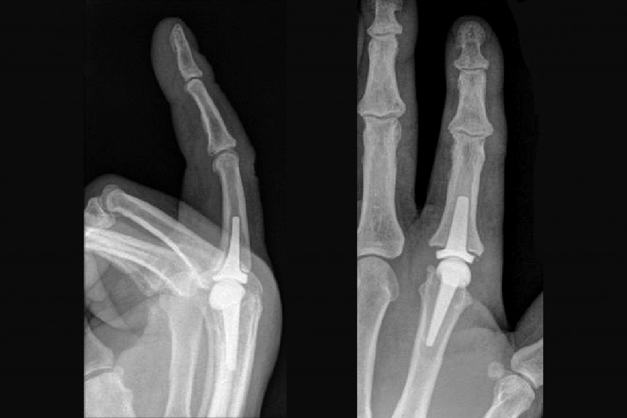 Advice and exercises following an ascension MCP joint replacement ...