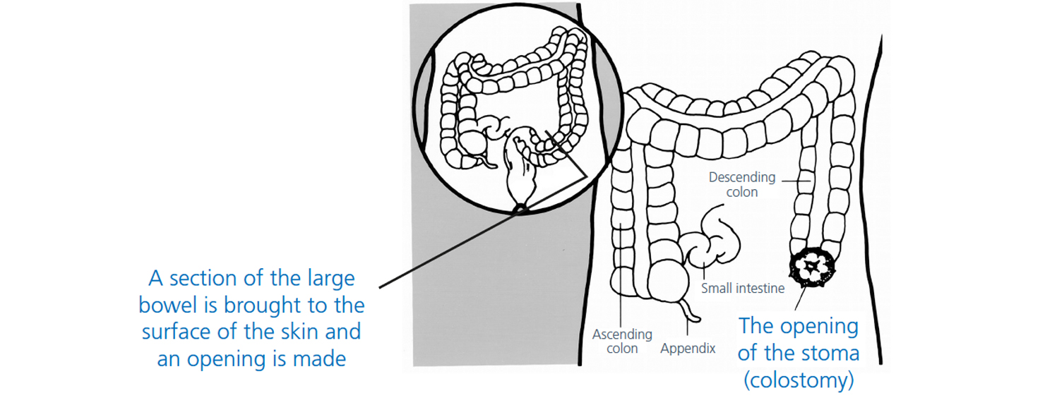Primary debulking surgery for an abdominal or pelvic mass - South Tees ...