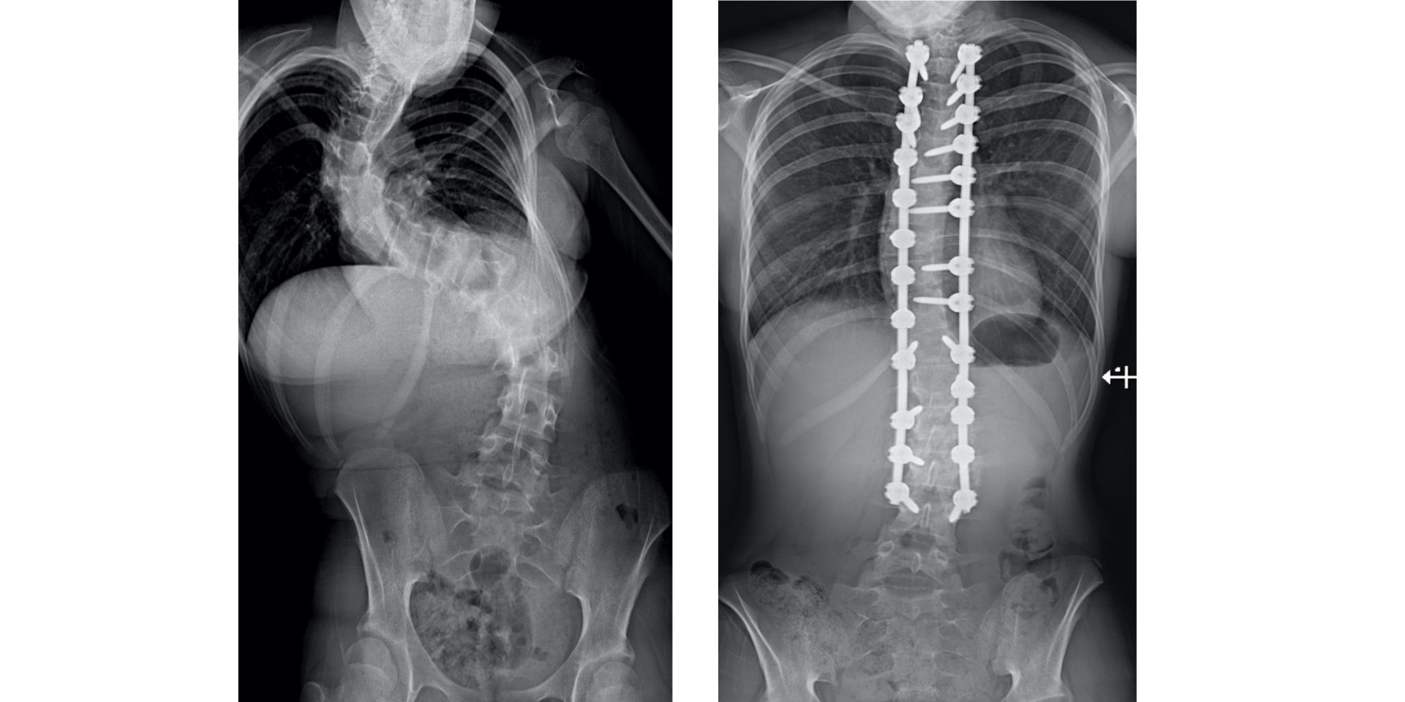 Scoliosis surgery - South Tees Hospitals NHS Foundation Trust