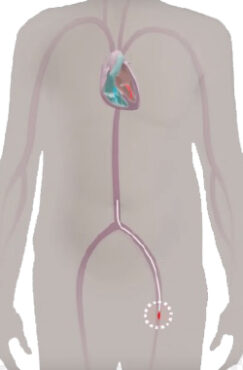 Treatment options for severe Aortic Stenosis: Deciding between surgery ...