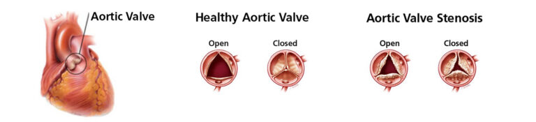 Treatment options for severe Aortic Stenosis: Deciding between surgery ...