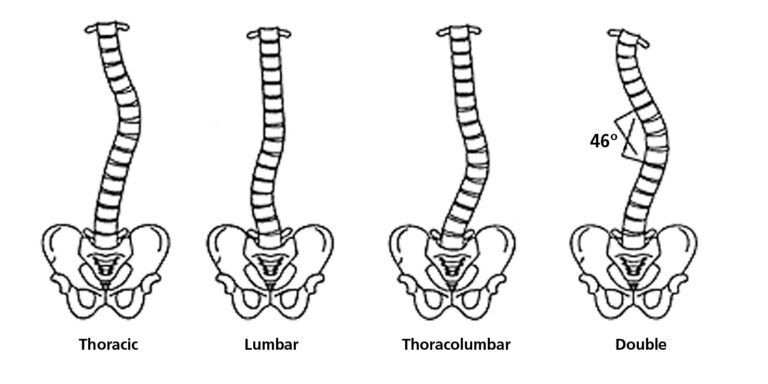 Scoliosis - South Tees Hospitals NHS Foundation Trust