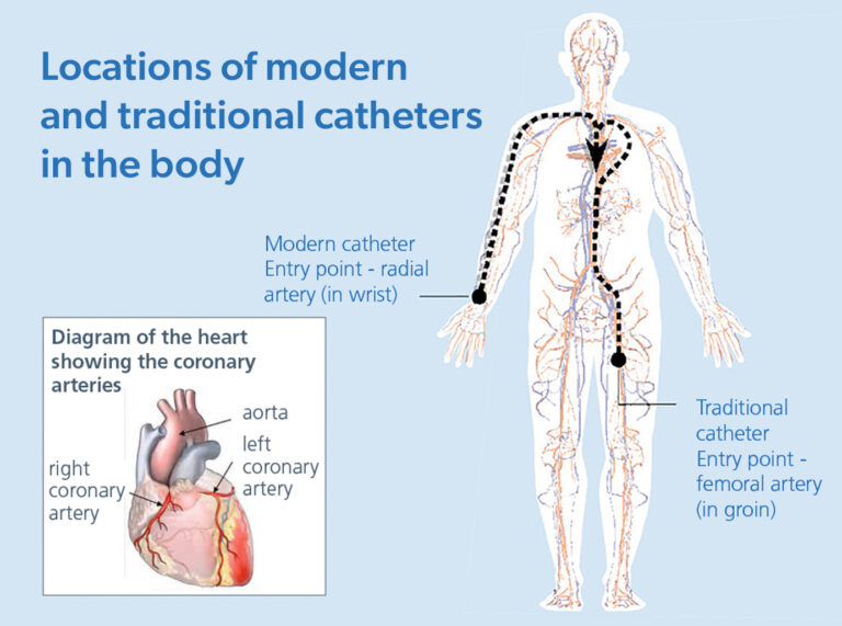Coronary angiography - South Tees Hospitals NHS Foundation Trust