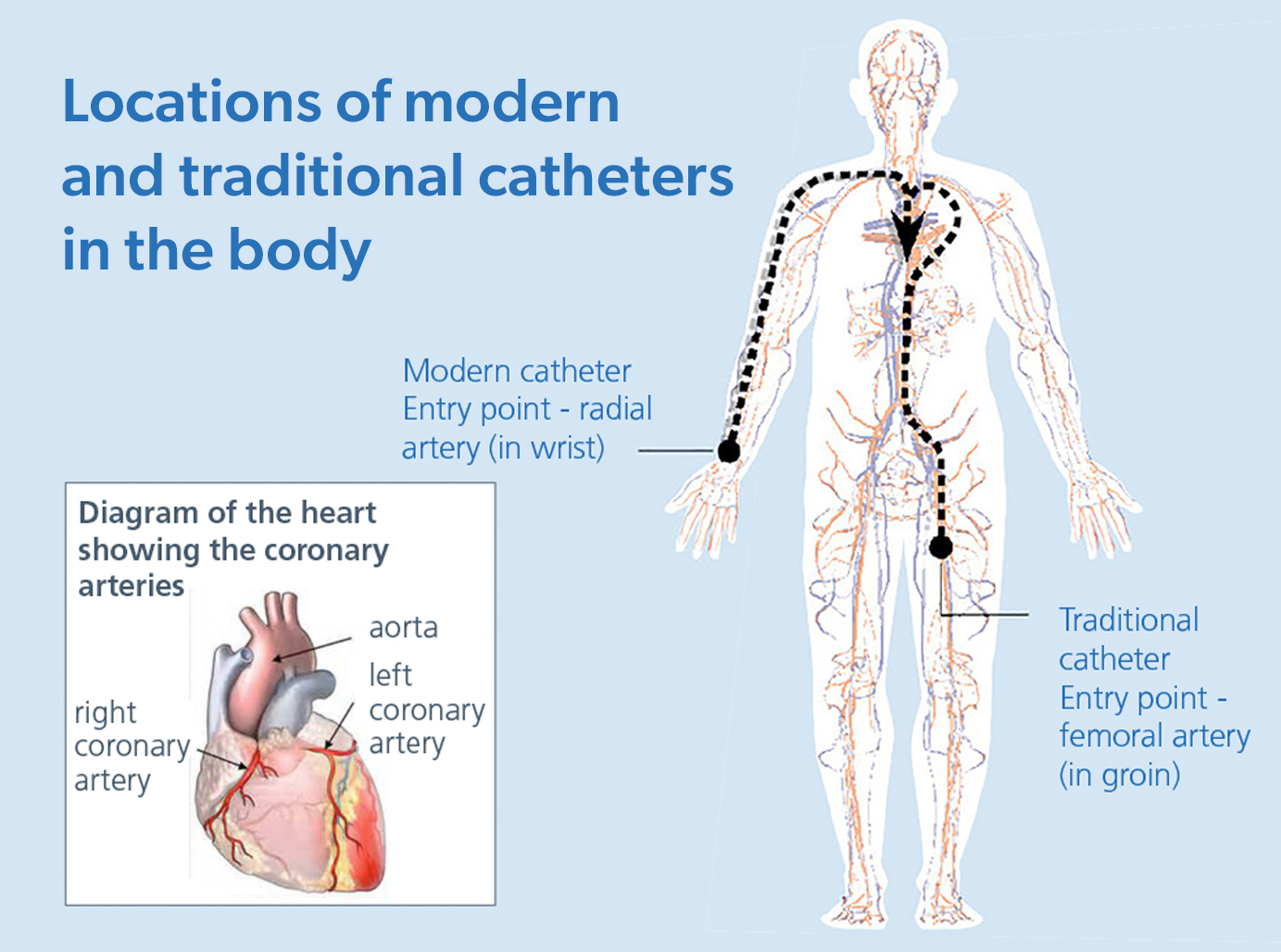 Coronary angiography - South Tees Hospitals NHS Foundation Trust