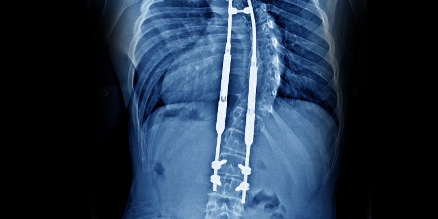 Growing rods - South Tees Hospitals NHS Foundation Trust