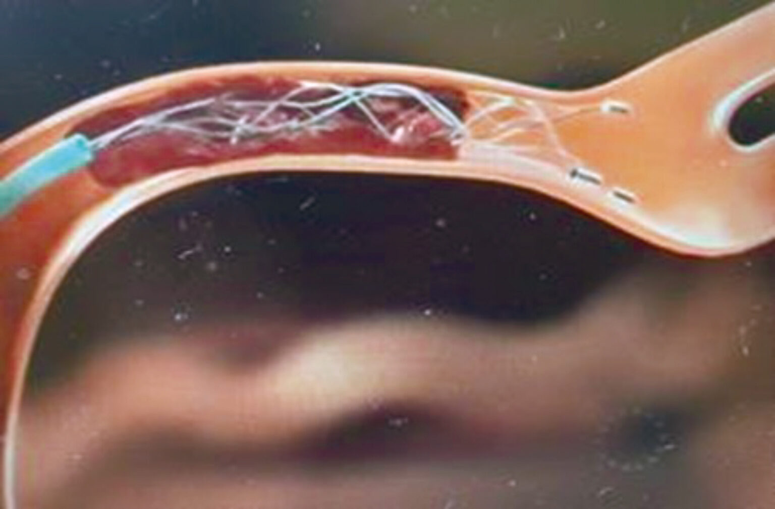 Mechanical thrombectomy - South Tees Hospitals NHS Foundation Trust