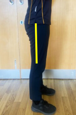 Gluteal tendinopathy (GTPS) - South Tees Hospitals NHS Foundation Trust