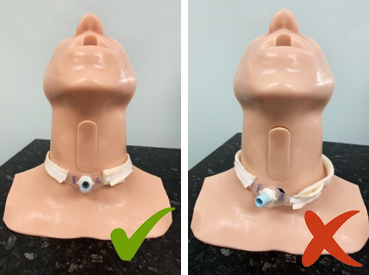 Discharge information - Tracheostomy - South Tees Hospitals NHS ...
