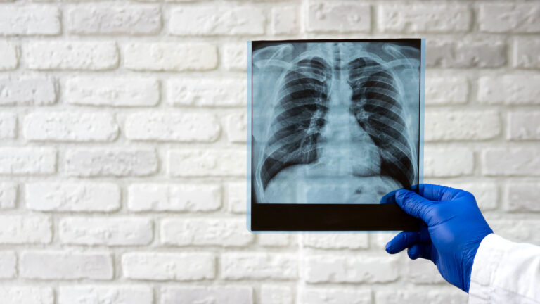 Chest wall service - South Tees Hospitals NHS Foundation Trust