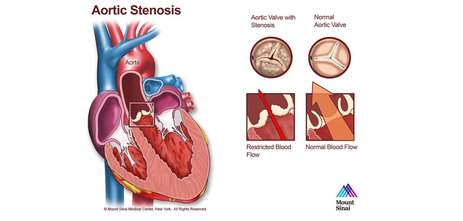 TAVI (Transcatheter Aortic Valve Implantation) - South Tees Hospitals ...