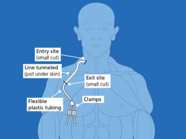 Hickman Line and PICC - South Tees Hospitals NHS Foundation Trust