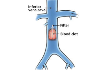 Inferior Vena Cava (IVC) filter insertion or retrieval - South Tees ...