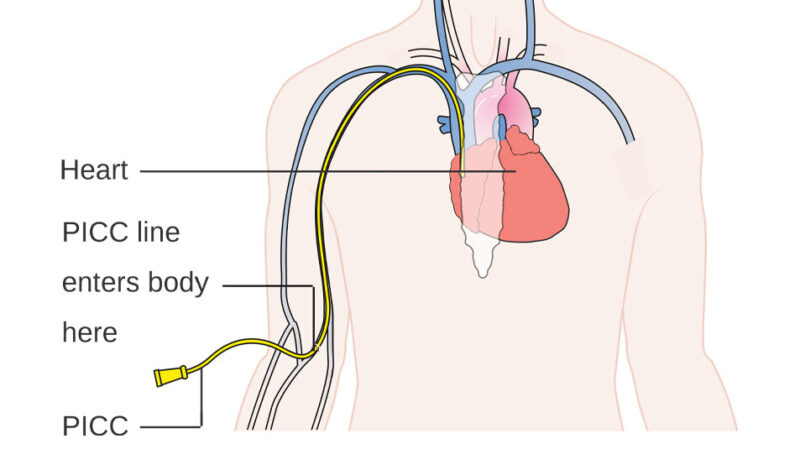 Hickman Line and PICC - South Tees Hospitals NHS Foundation Trust