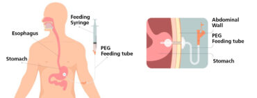 Radiologically inserted gastrostomy (RIG) tube - South Tees Hospitals ...