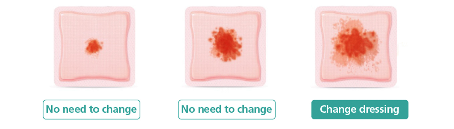 Looking after your caesarean section wound at home - South Tees ...