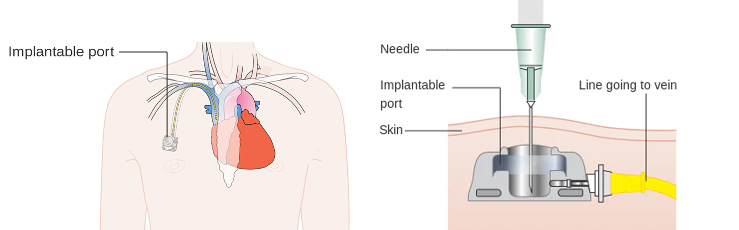 Portacath - South Tees Hospitals NHS Foundation Trust