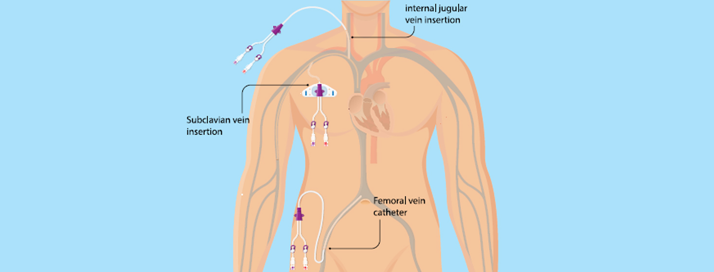 Dialysis line insertion - South Tees Hospitals NHS Foundation Trust