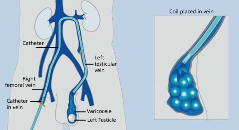 Varicocele embolisation - South Tees Hospitals NHS Foundation Trust