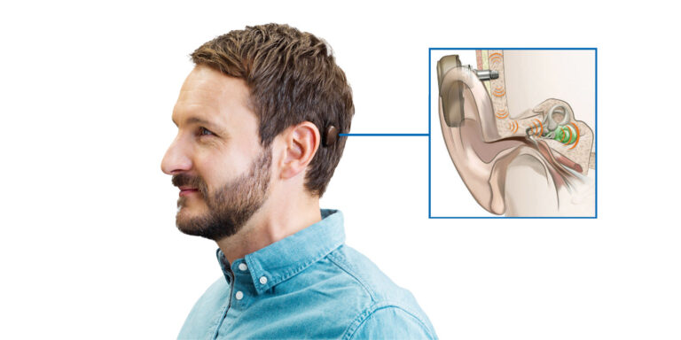 Bone conduction implantable solution - South Tees Hospitals NHS ...