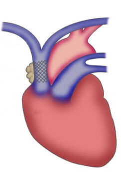 Superior Vena Cava (SVC) stent insertion - South Tees Hospitals NHS ...