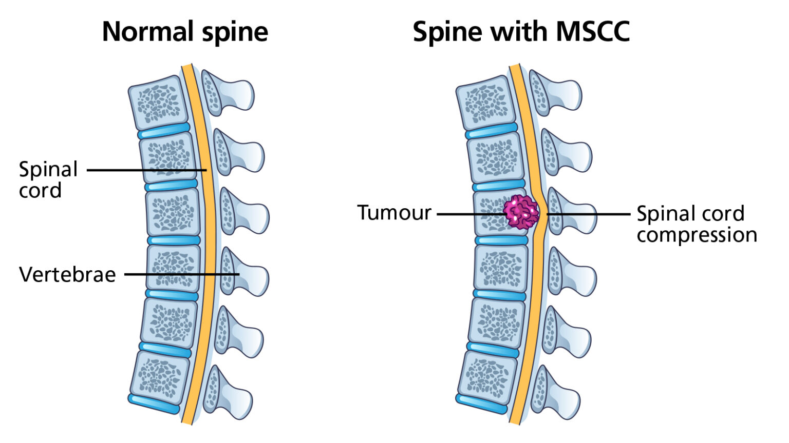 Metastatic spinal cord compression information for patients - South ...