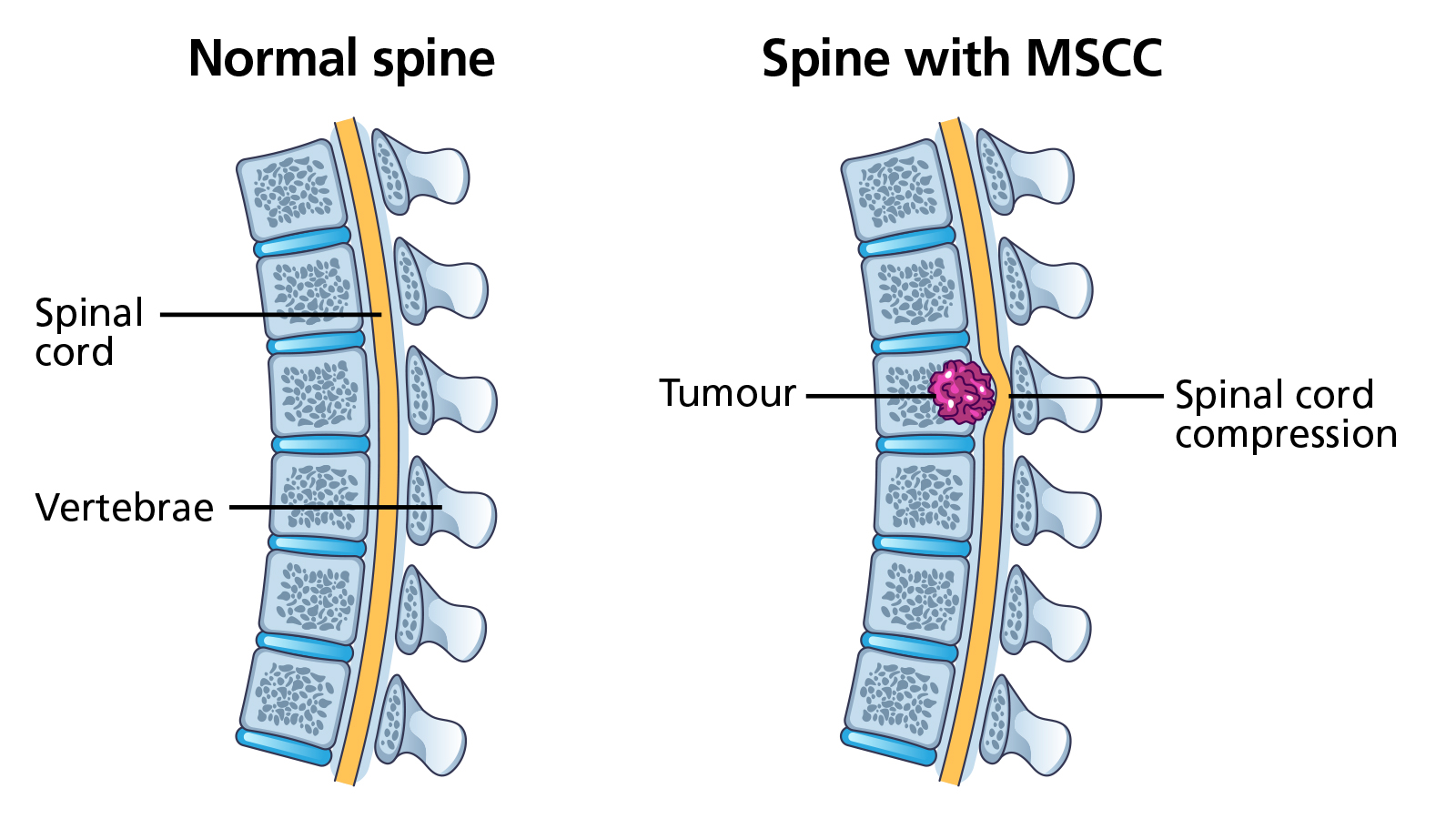 Metastatic spinal cord compression information for patients - South ...