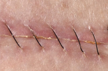 Post operative wound care - South Tees Hospitals NHS Foundation Trust