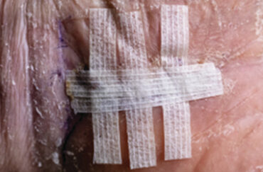 Post operative wound care - South Tees Hospitals NHS Foundation Trust