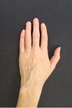 Advice and Exercises Following Trapeziectomy - South Tees Hospitals NHS ...