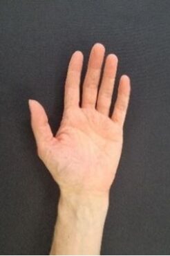 Advice and Exercises Following Trapeziectomy - South Tees Hospitals NHS ...