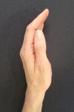 Advice and Exercises Following Trapeziectomy - South Tees Hospitals NHS ...