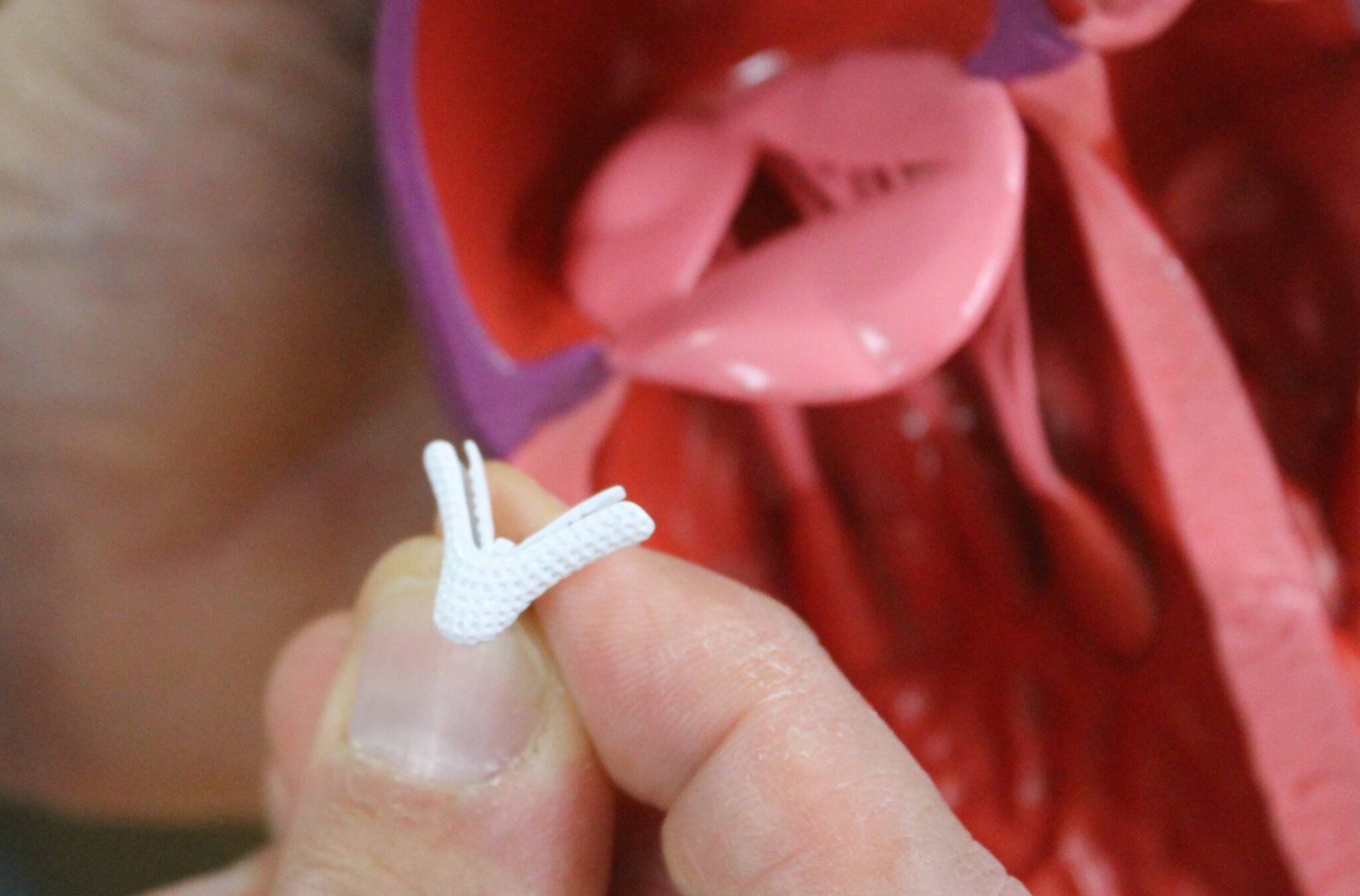 Pioneering heart procedure transforms patients’ lives - South Tees ...
